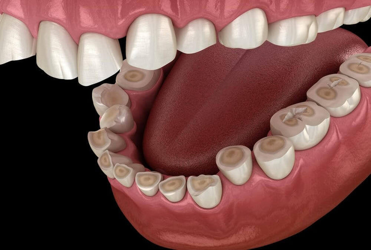 What Causes Tooth Enamel Erosion? A Guide on Enamel Erosion – Franklin ...