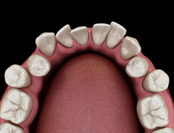 A Comprehensive Guide on How to Fix Misaligned Teeth – Franklin Dental ...