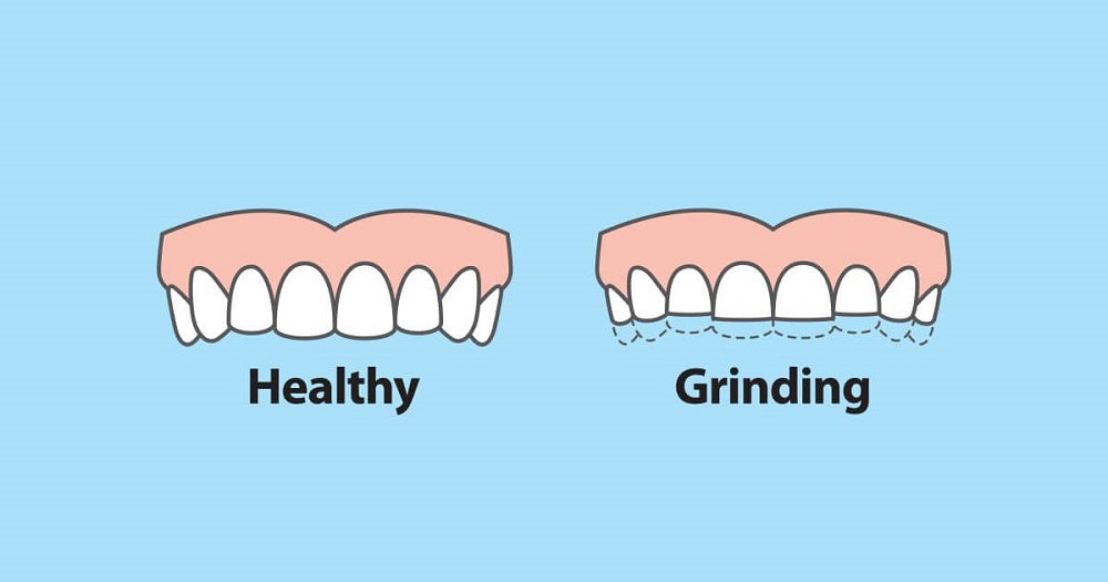 Bruxism Issue: How Long Does Teeth Grinding Pain Last – Franklin Dental ...