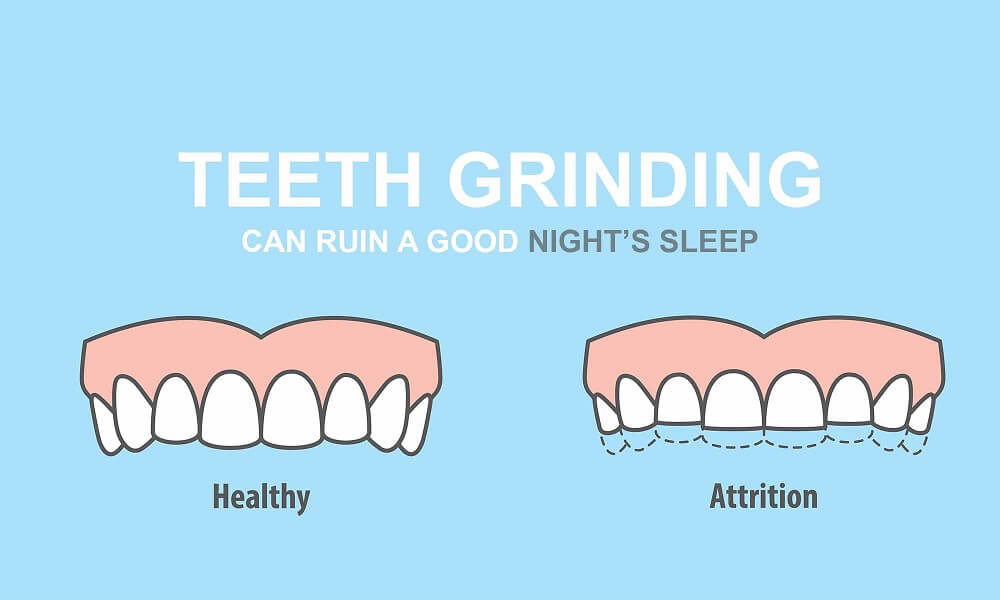 What Causes Teeth Grinding - Stress, Anxiety, Sleep Apnea, etc ...