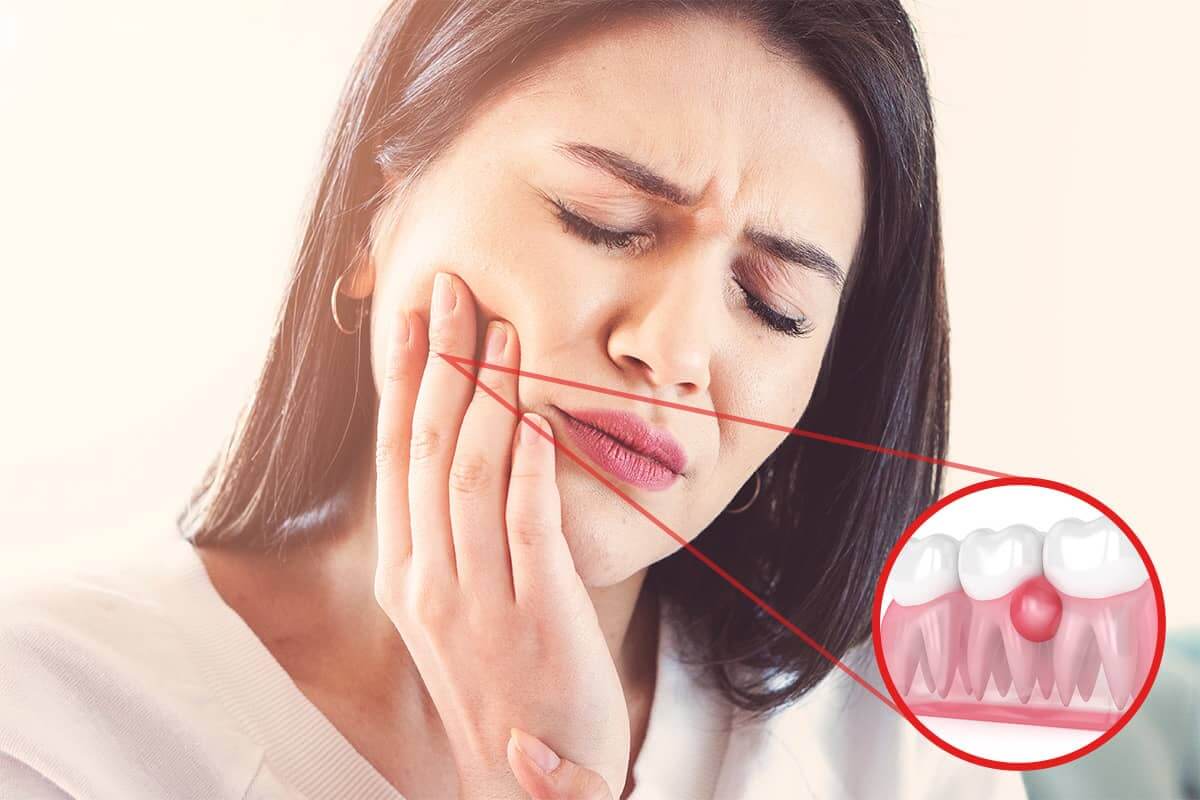 Tooth Abscess: What to Do If a Dental Abscess Bursts On Its Own ...