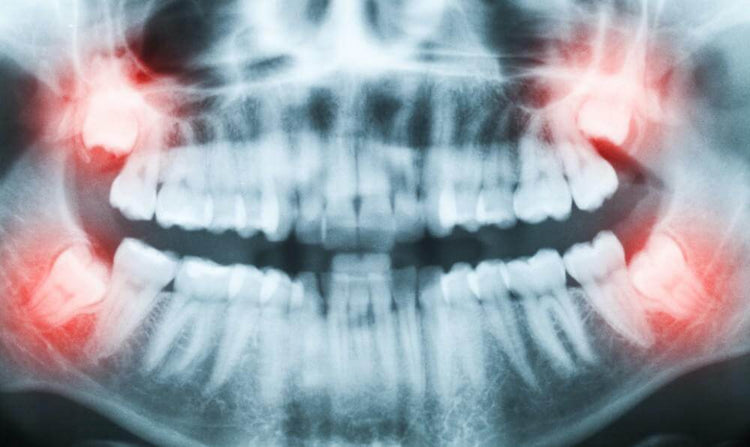 4 Surprising Benefits of Keeping Wisdom Teeth - 2023 Updated – Franklin ...
