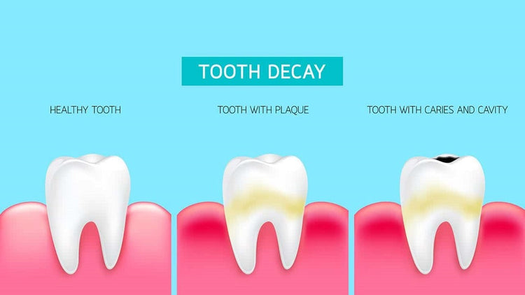 What Does Tooth Decay Look Like: Signs and Symptoms Revealed – Franklin ...